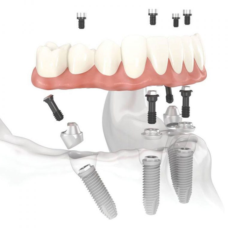 Fixed Dentures on Implants in Stony Plain